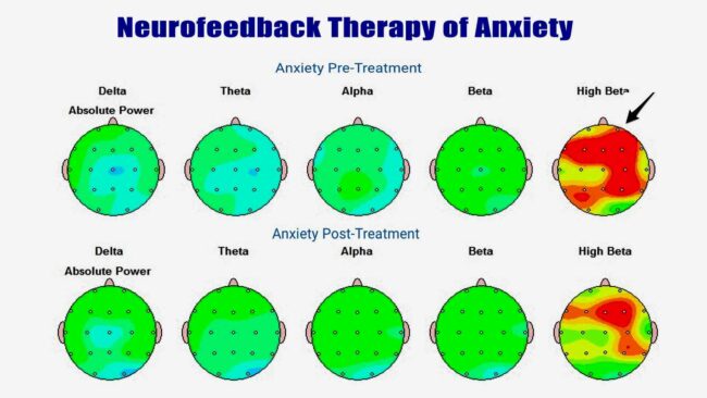 Neurofeedback Archives - BIOFEEDBACK NEUROFEEDBACK THERAPY